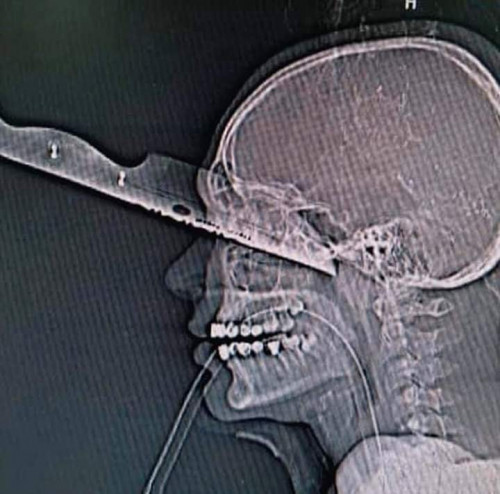 Surviving knife stab to the eye...