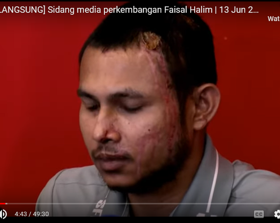 Faisal Halim teruk kesan kena simbah asid